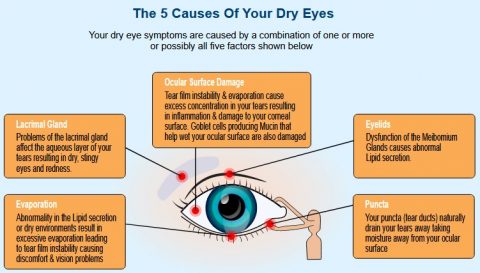 Dry Eye | Visual Answers